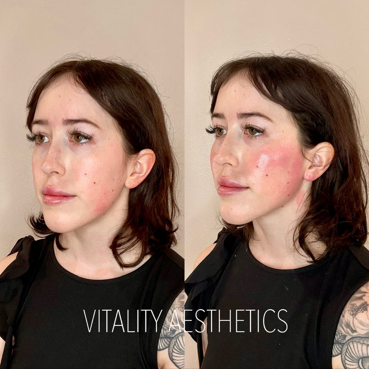 Bio-filler and PRF gel and everything in between! | Vitality Aesthetics